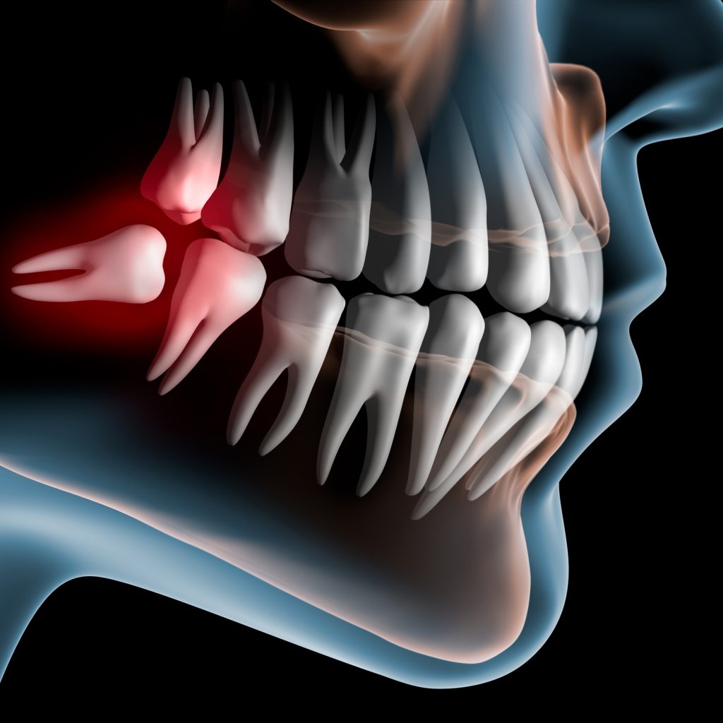 Wisdom Toot Removal – Rainbow Dental Hospital Kegalle